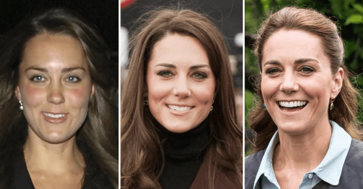 Celebrity Smile Makeover: Photos From Kate Middleton to David Beckham